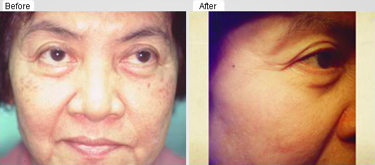 Laser Removal of NEVUS of OTA - Dermatologist Malaysia